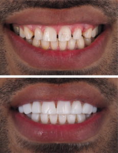 Composite Bonding — Smiles and Smiles
