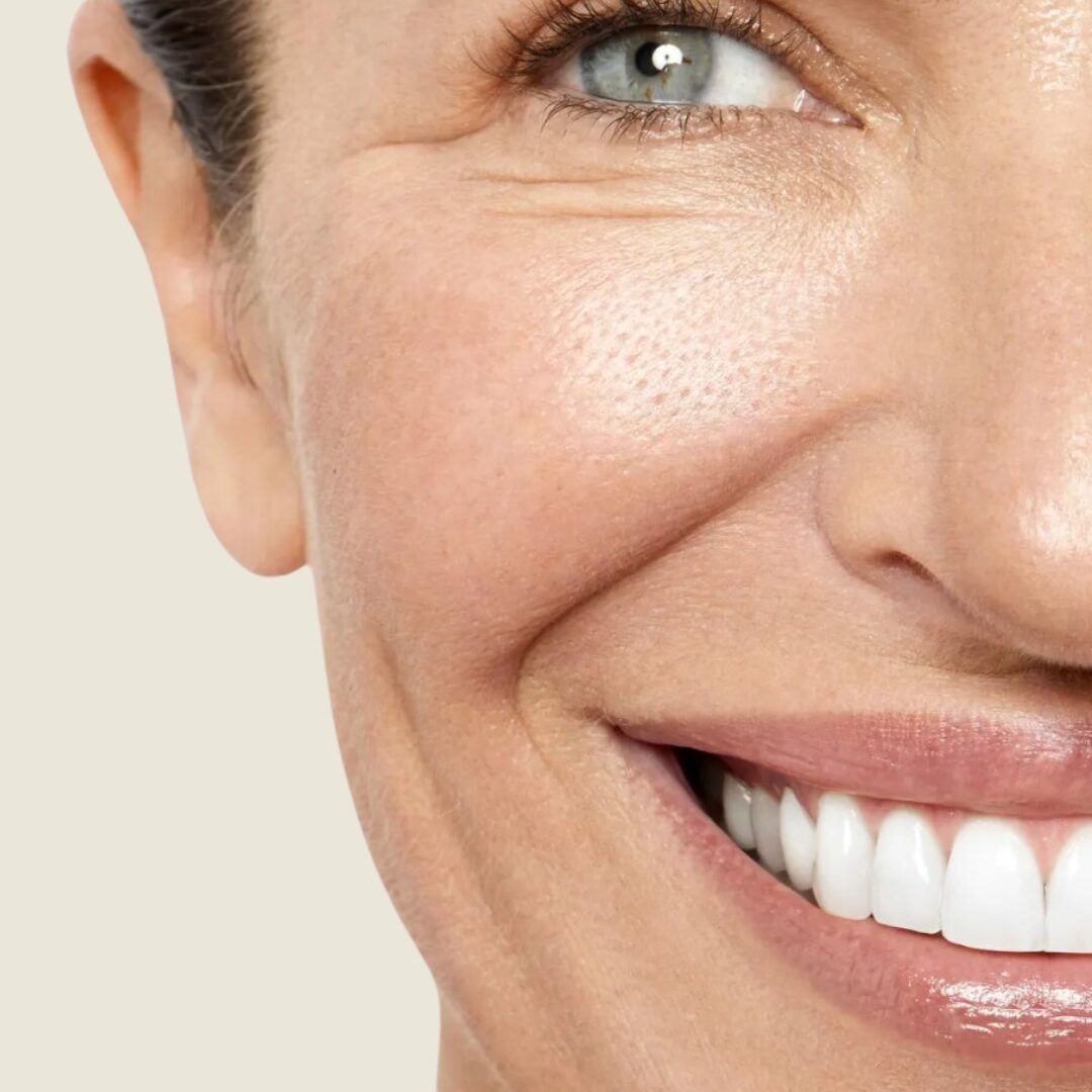 Digital Composite Bonding — Smiles and Smiles